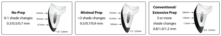 Porcelain Veneer Prepping 101 - Burbank Dental Lab