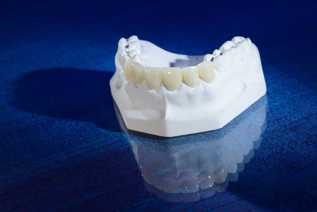 Digital Impression: A Guide To Scannable Abutments - Burbank Dental Lab