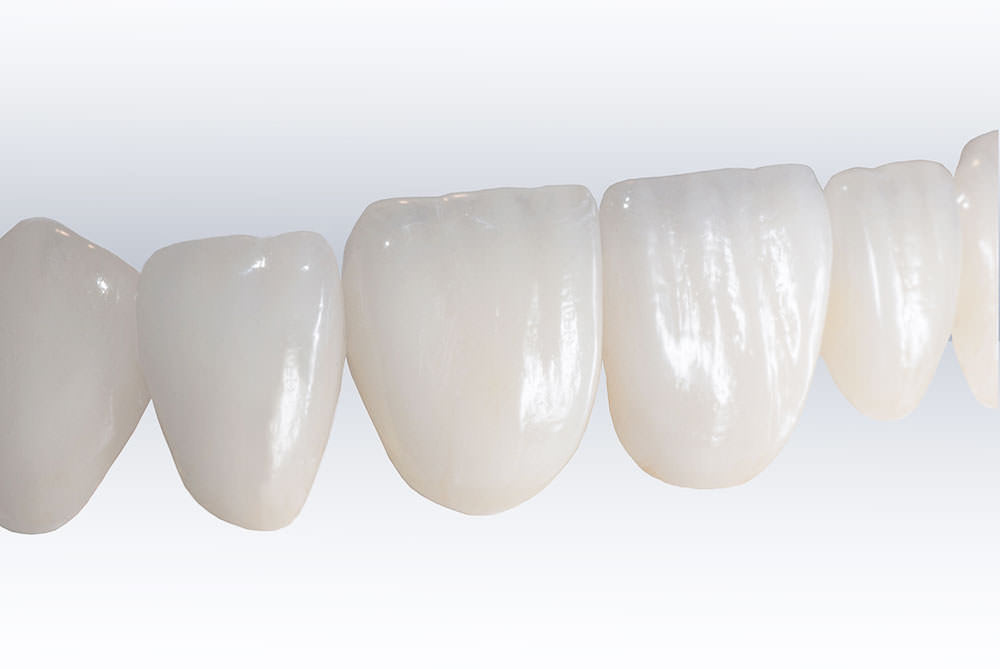 Ceramic and Porcelain Veneers - Burbank Dental Lab