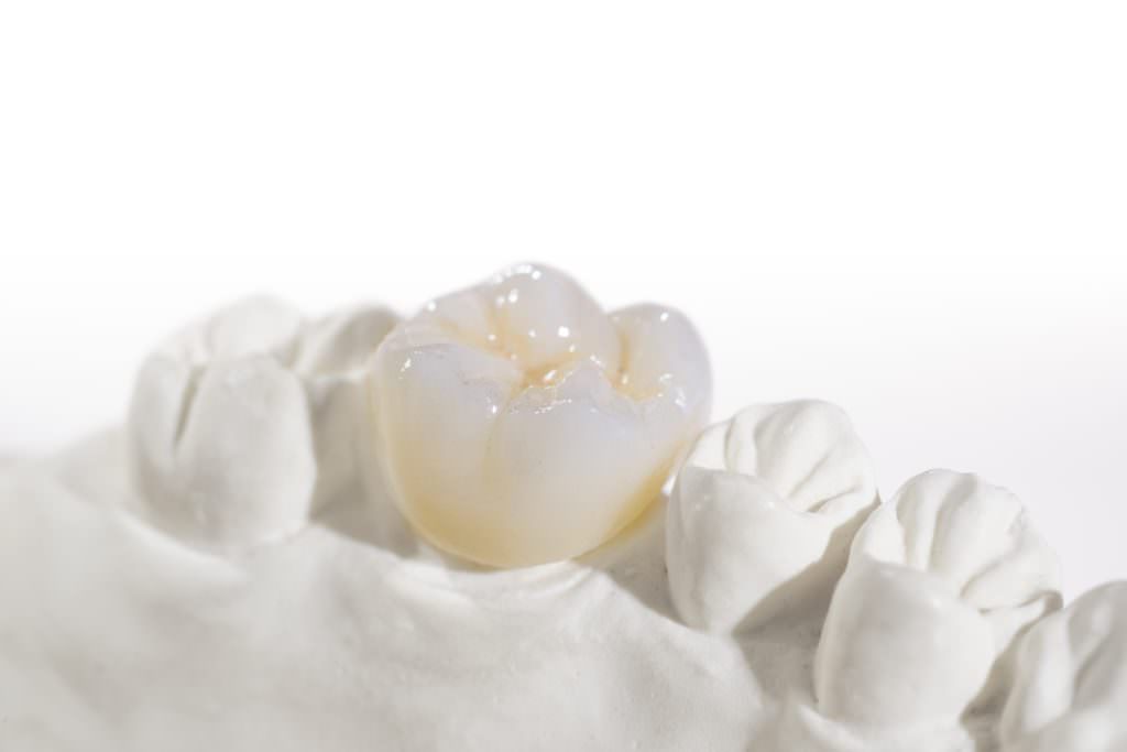 IPS e.max® Restorations for Crowns & Bridges - Burbank Dental Lab
