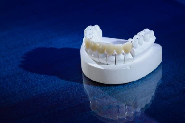 IPS E.max: Strength, Esthetics, Success - Burbank Dental Lab