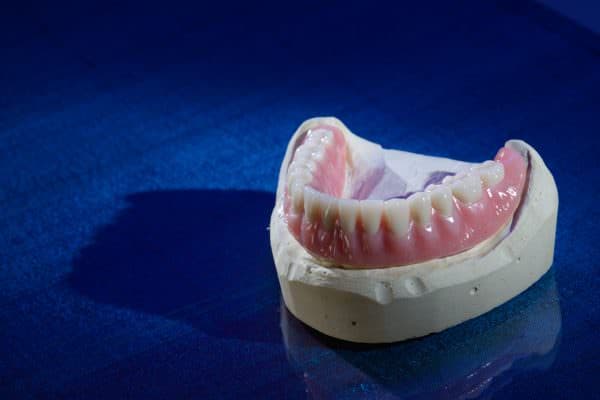 Implant-Assisted Removable Partial Dentures - Burbank Dental Lab