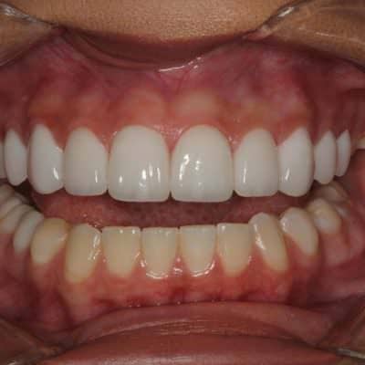 Smile Gallery Before And After - Burbank Dental Lab