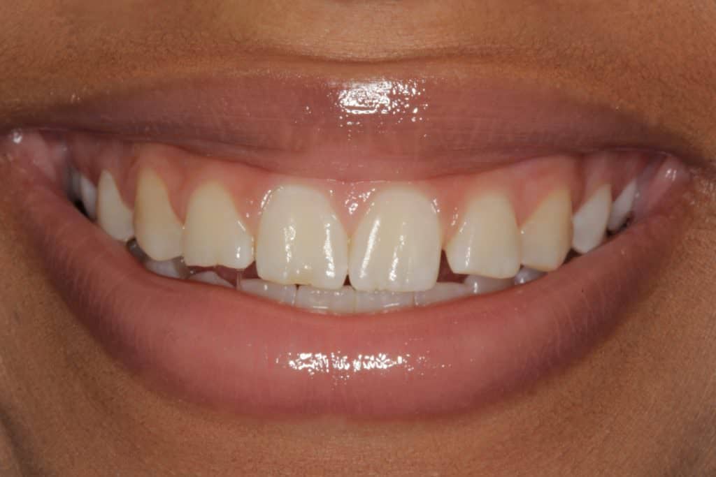 Smile Gallery Before and After - Burbank Dental Lab