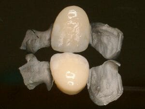 Single Tooth Restoration Options: Evaluating Maryland Bridges