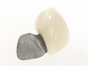 Single Tooth Restoration Options: Evaluating Maryland Bridges