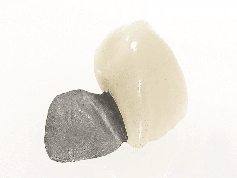 Single Tooth Restoration Options: Evaluating Maryland Bridges