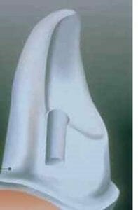 Single Tooth Restoration Options: Evaluating Maryland Bridges