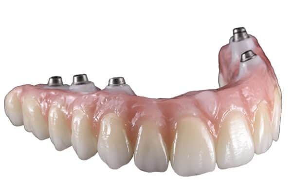 Burbank Dental Lab - Esthetic all-ceramics, implant restorations, dentures