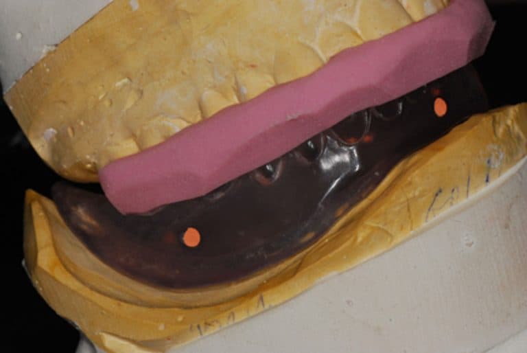 Guided Surgery Appliance Restorations - Burbank Dental Lab