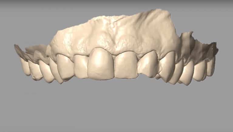 Beyond Imaging - 3D Digital Wax-up And Digital Provisionals