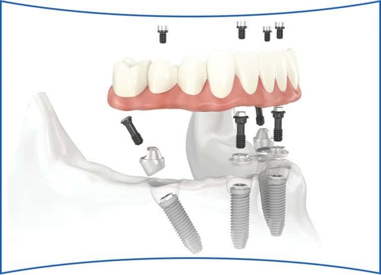 Multi-Unit Abutments: When And How To Use Them - Burbank Dental Lab