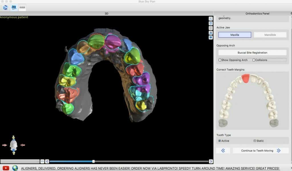 Add Alignment To Your Dental Practice With Blue Sky - Burbank Dental Lab