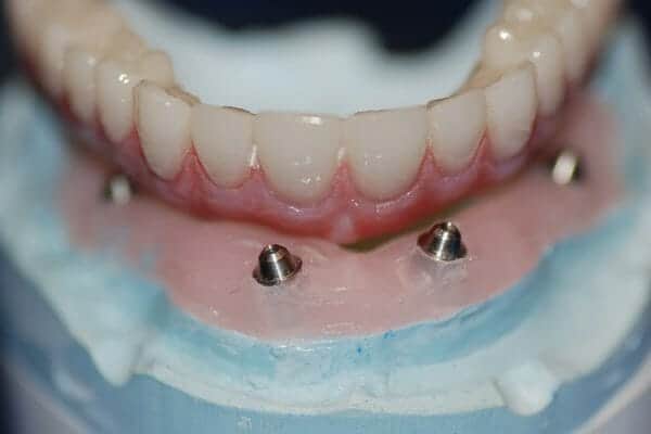 Multi-Unit Abutments: When And How To Use Them - Burbank Dental Lab