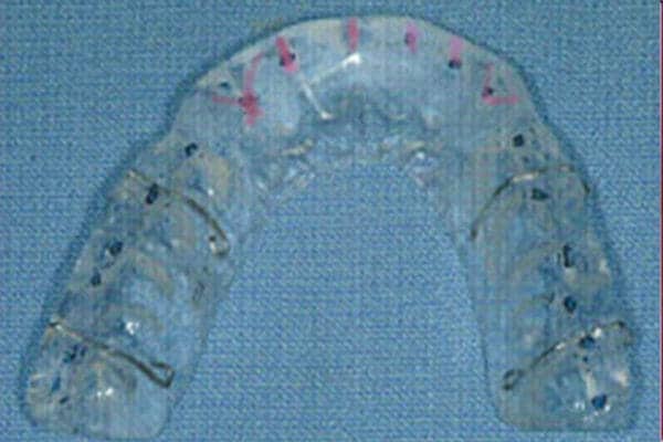 Occlusal Guards And Splints - Burbank Dental Lab