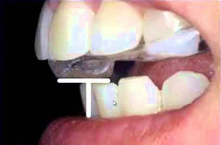 Occlusal Guards And Splints - Burbank Dental Lab