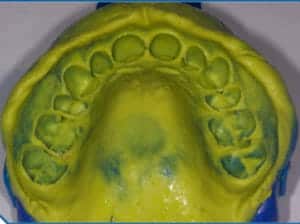 Occlusal Guards And Splints - Burbank Dental Lab