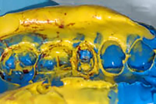 Impression Trouble-Shooting Guide - Burbank Dental Lab