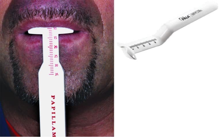 Dentures In ONLY 3 Appointments - Burbank Dental Lab