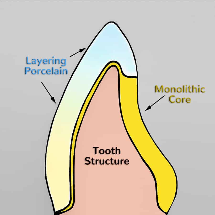 Making An Informed Decision When Prescribing All-Ceramic Restorations