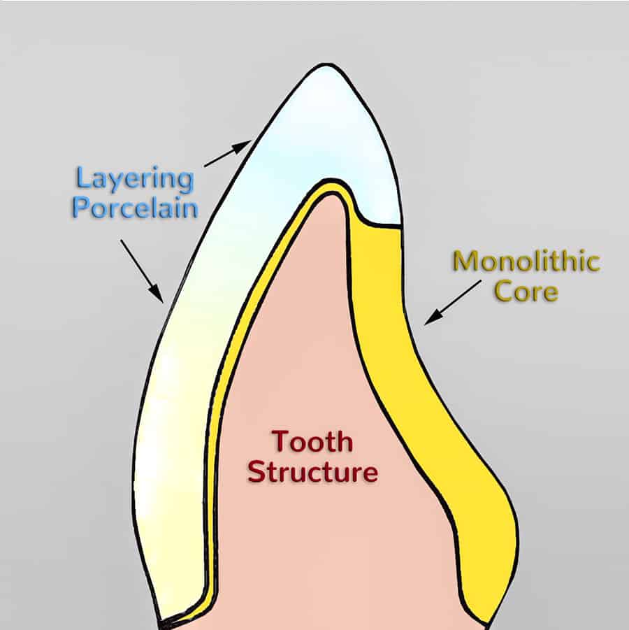 Making An Informed Decision When Prescribing All-Ceramic Restorations
