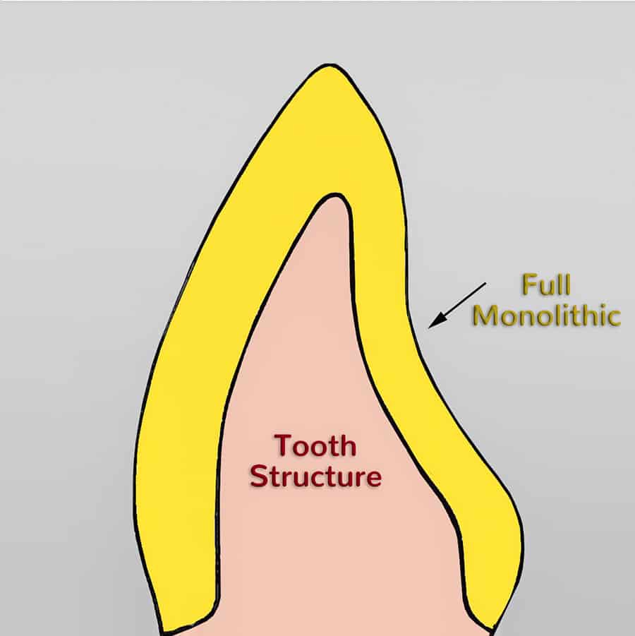 Making An Informed Decision When Prescribing All-Ceramic Restorations