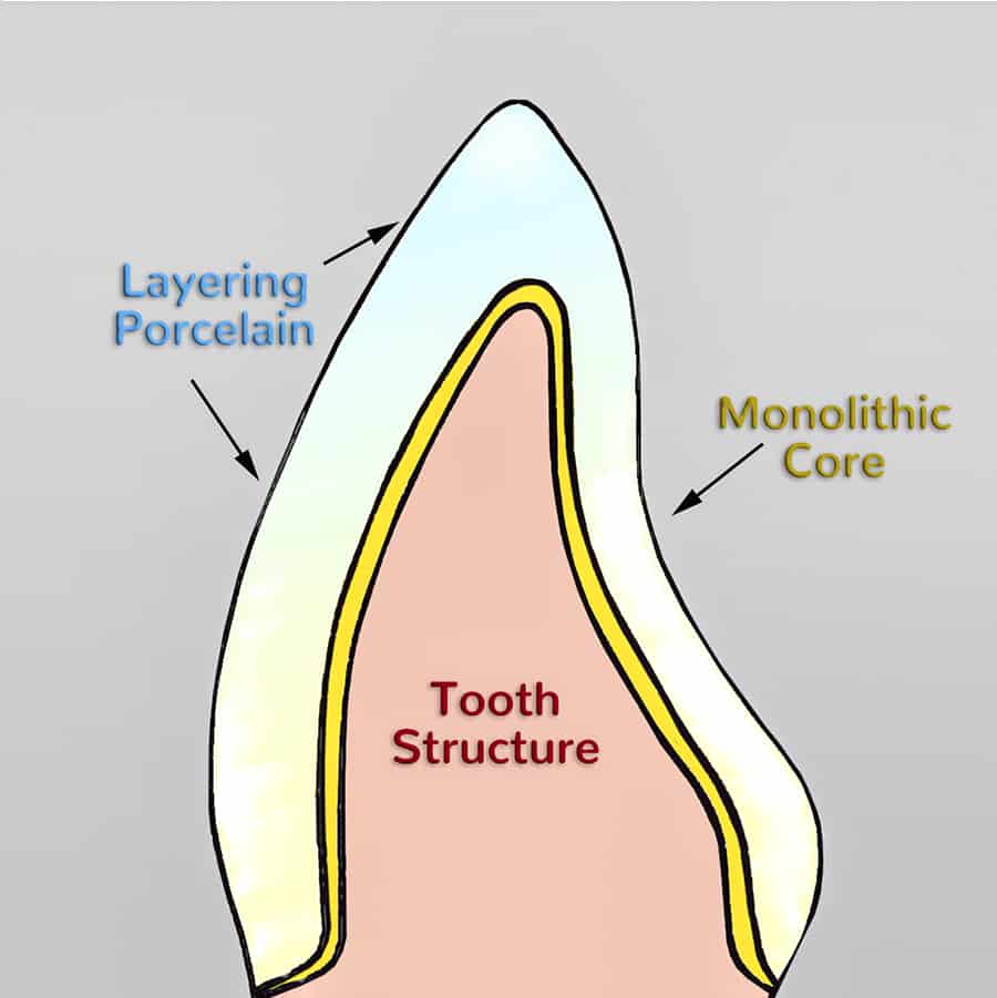 Making An Informed Decision When Prescribing All-Ceramic Restorations