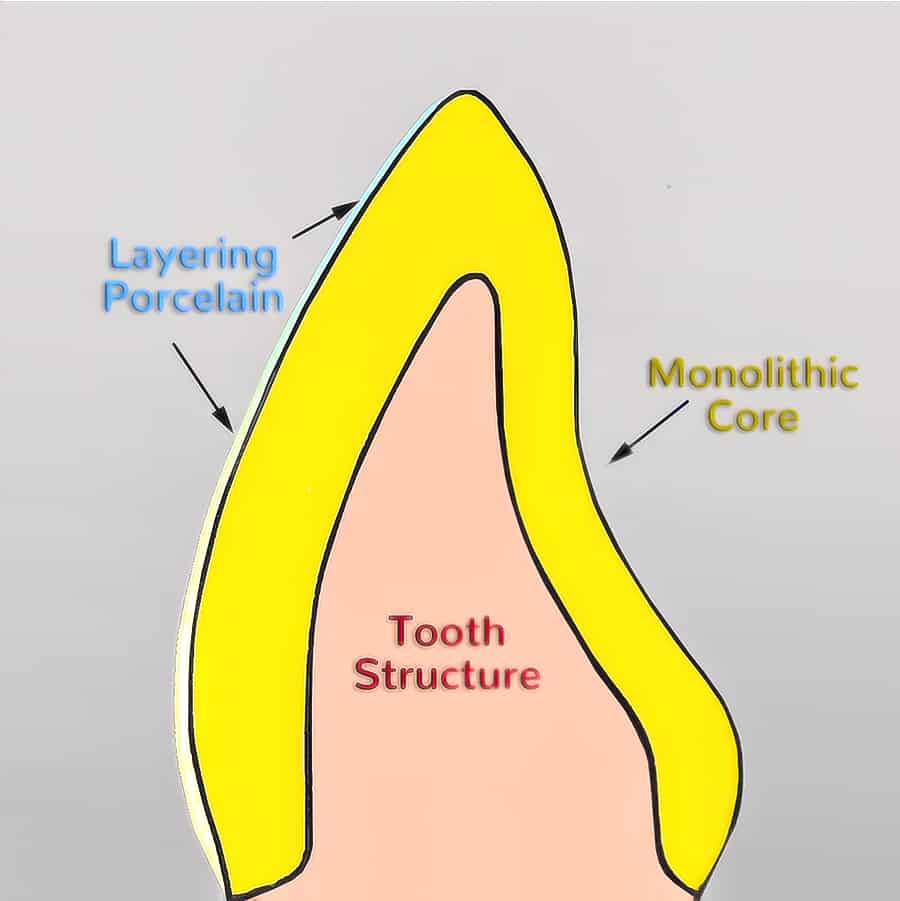 Making An Informed Decision When Prescribing All-Ceramic Restorations