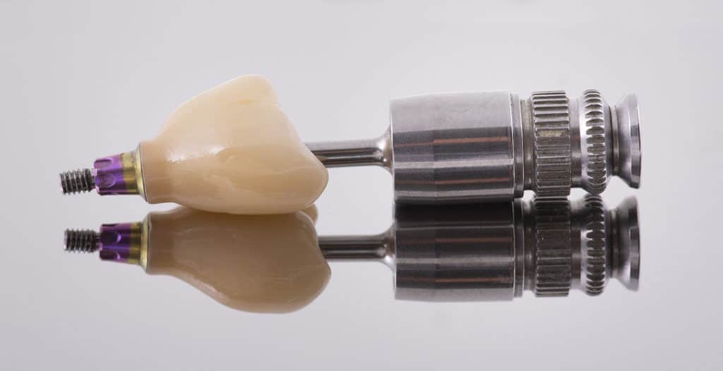 Implant Retention Methods: Critical Decisions for Success - Burbank ...