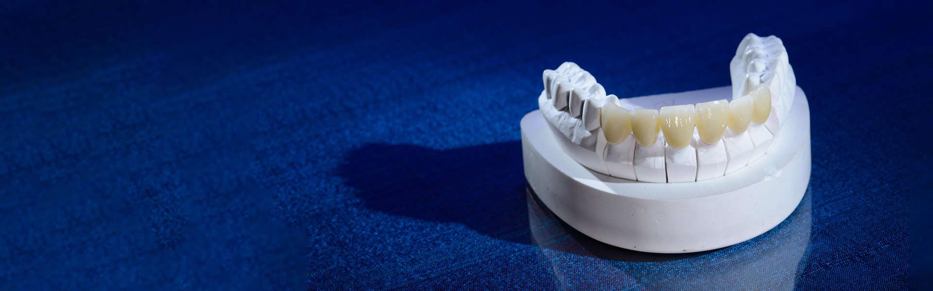 IPS e.max: Strength, Esthetics, Success - Burbank Dental Lab