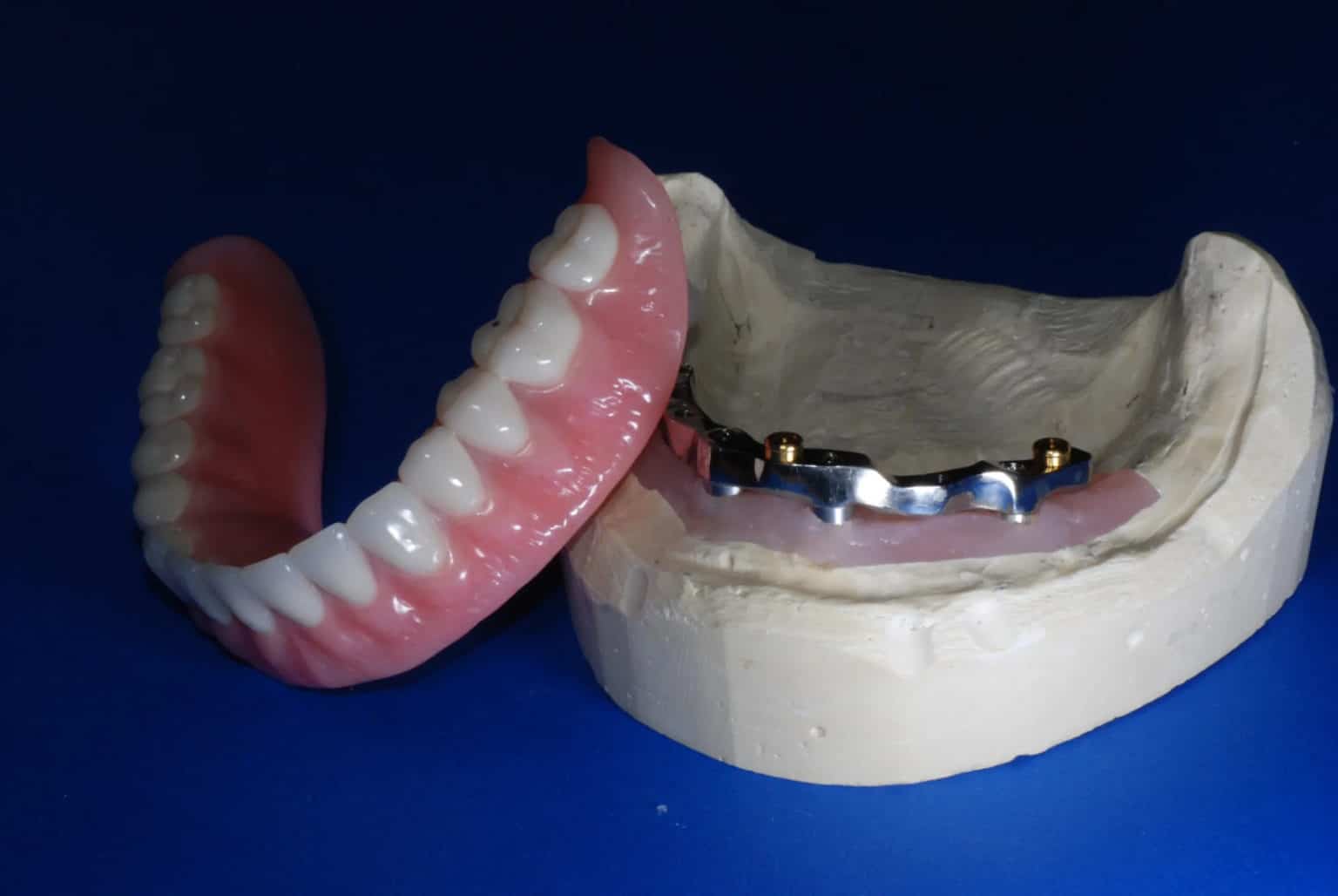Smart1 Implant Bar Overdentures - Burbank Dental Lab - Best Dental Lab