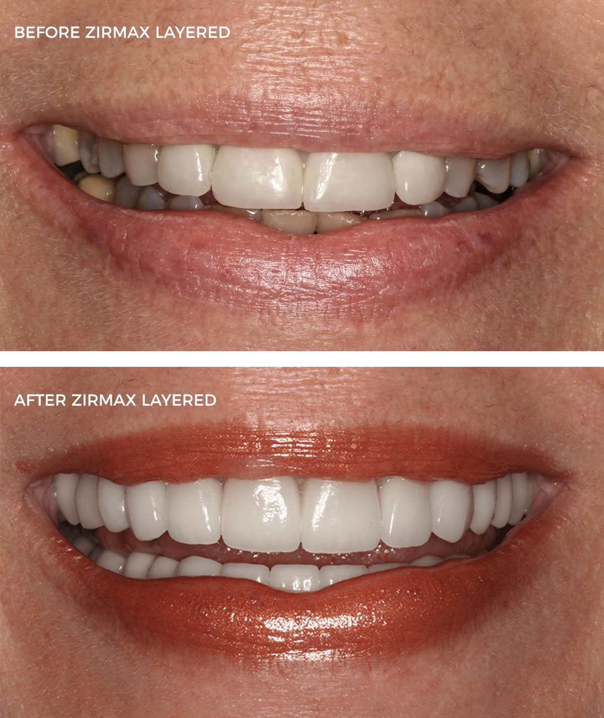 Dental Zirconia: Tips For Success - Burbank Dental Lab