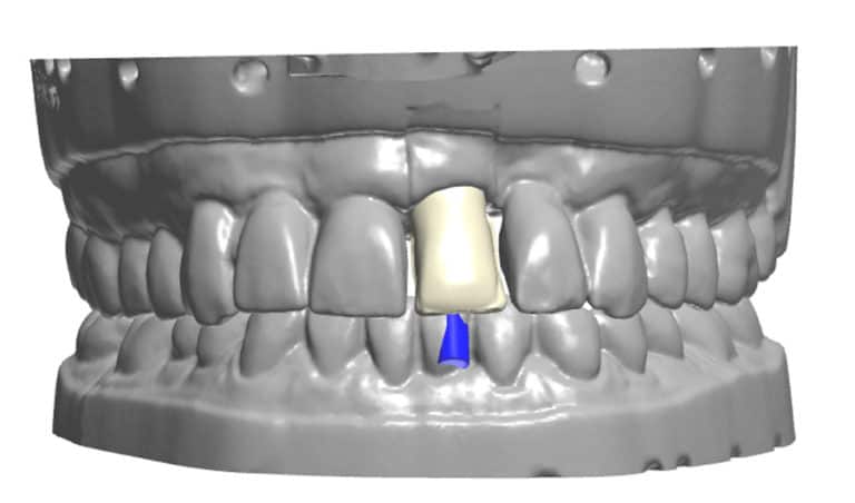 Precision Manufacturing: Single-Unit Implant - Burbank Dental Lab