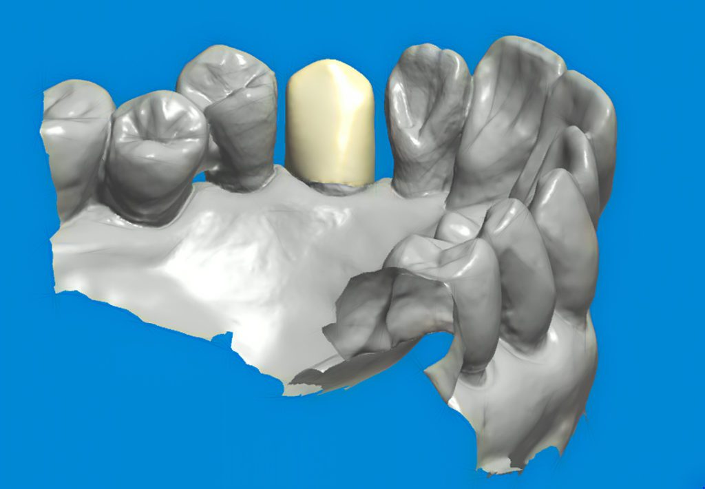 Matching The Single Unit: Layered Zirconia - Burbank Dental Lab