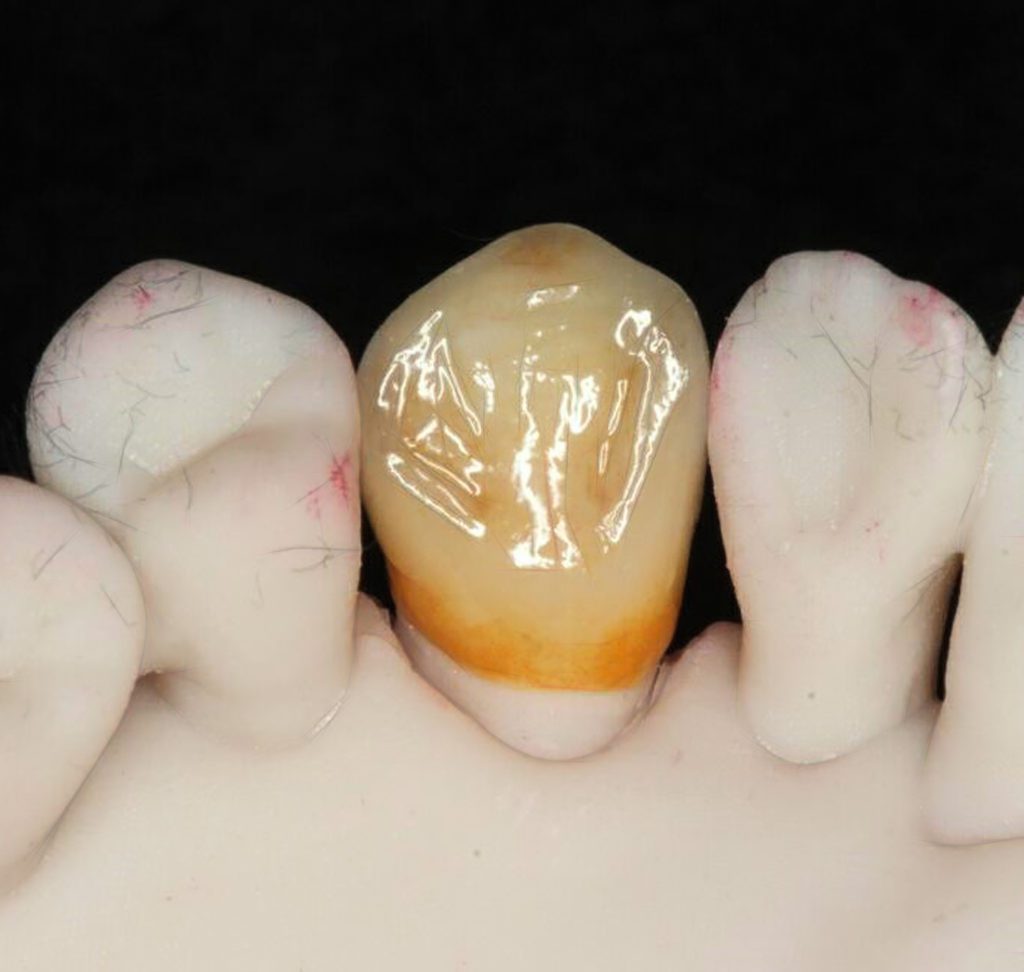 Matching The Single Unit: Layered Zirconia - Burbank Dental Lab