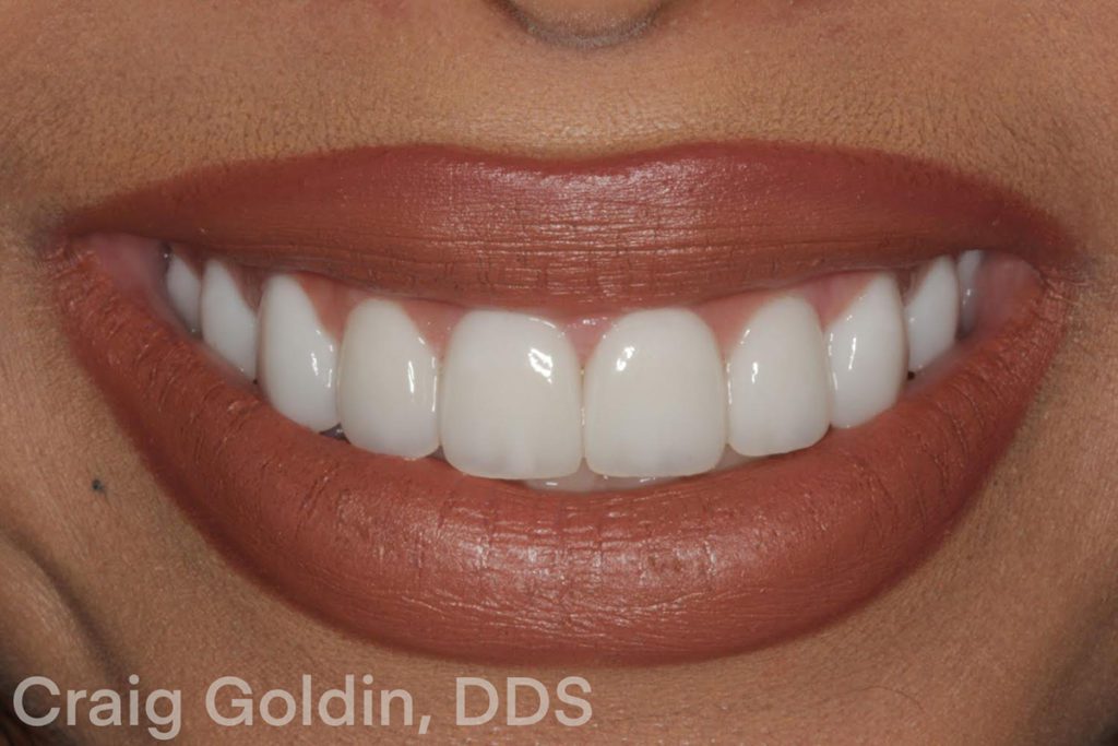 E-max Layered Veneers: From Plan To Perfect Result - Burbank Dental Lab