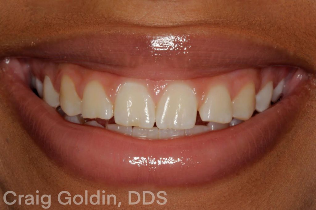 E-max Layered Veneers: From Plan To Perfect Result - Burbank Dental Lab