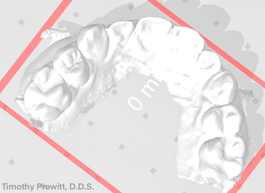 Porcelain Veneer Success - Burbank Dental Lab