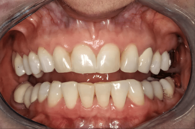 DuraTemp: It's All In The Planning - Burbank Dental Lab