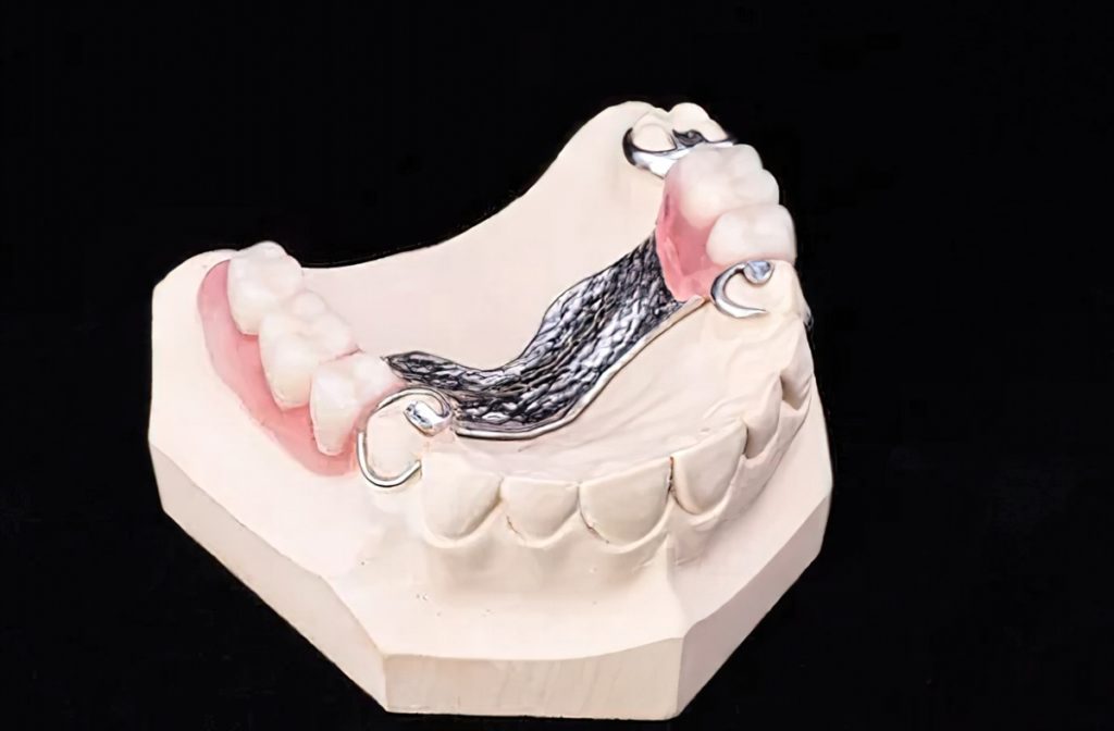 VALPLAST: Success With Partial Dentures - Burbank Dental Lab