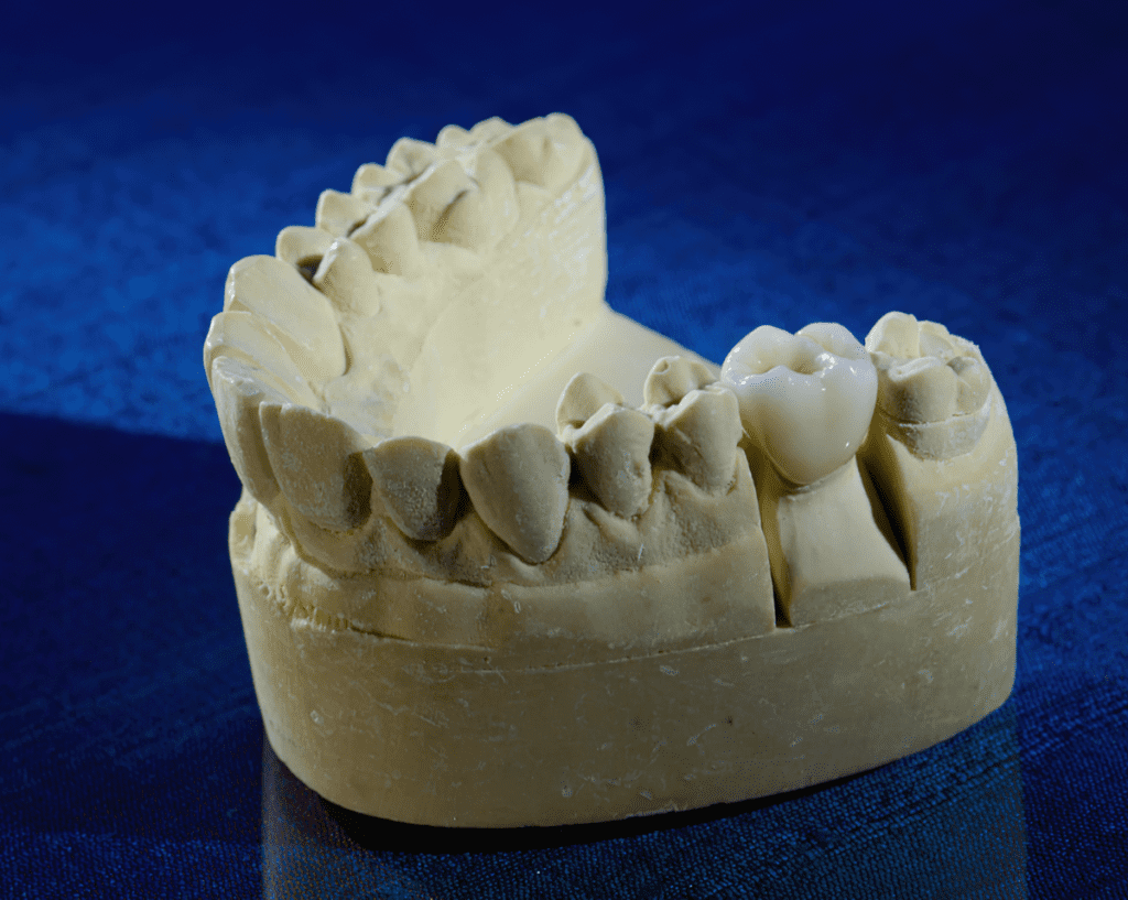 Are PFMs Still A Viable Treatment? Zirconia Vs. PFM