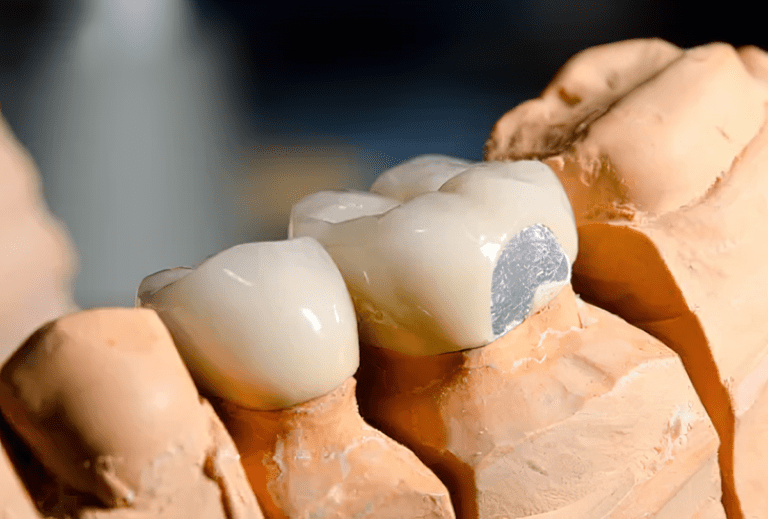 Are PFMs Still A Viable Treatment? Zirconia Vs. PFM