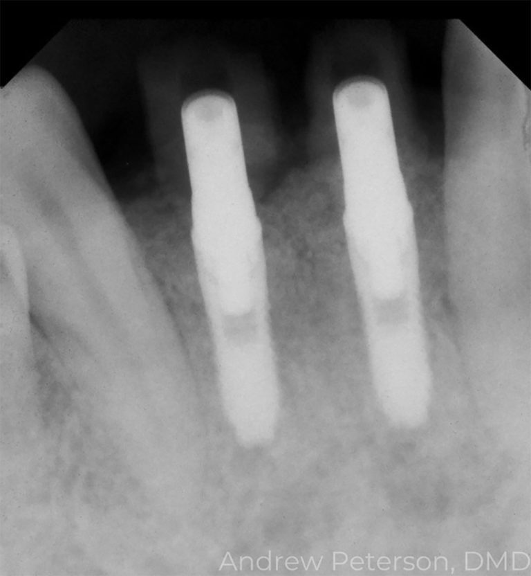 Implant Placement And Provisionalization In Advanced Gum Disease ...