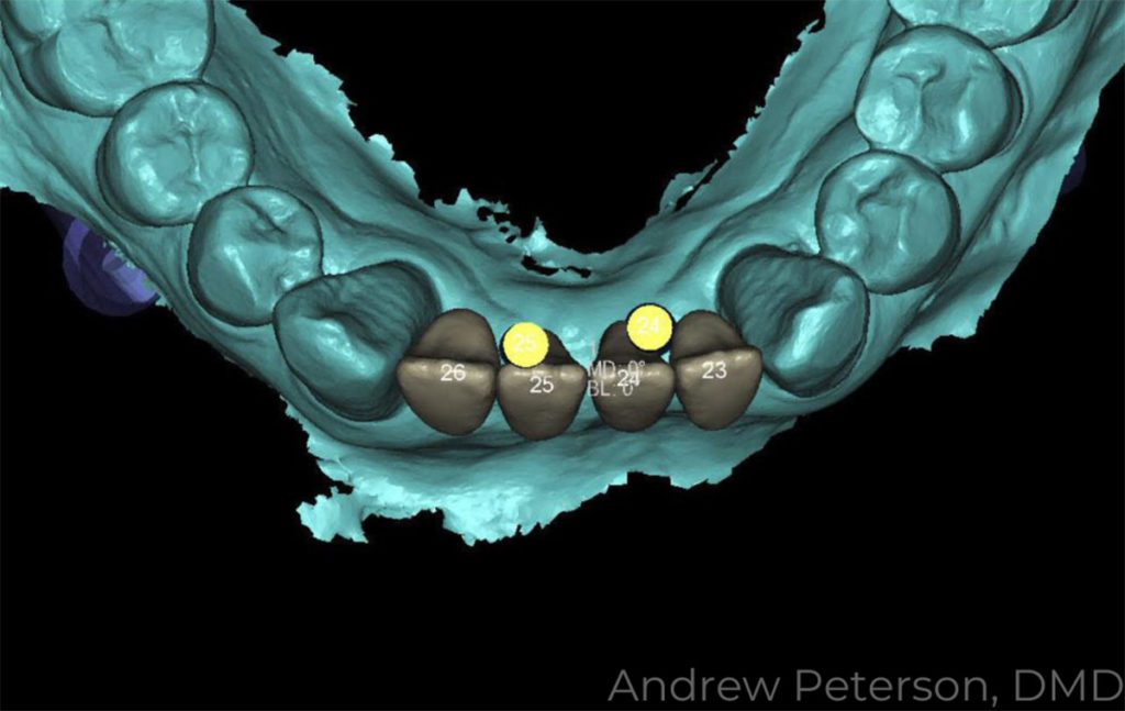 Implant Placement And Provisionalization In Advanced Gum Disease ...
