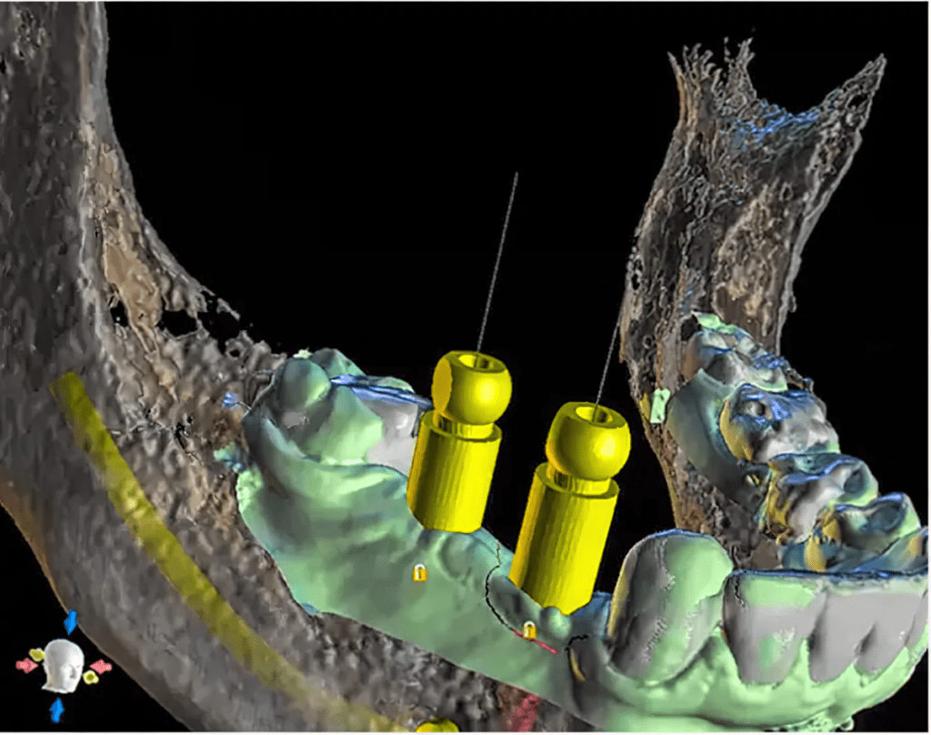 Improving Implant Success Using Custom Healing Abutments - Burbank ...