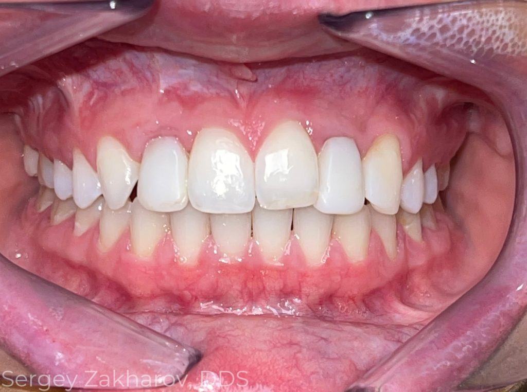 Smiles By Design: E.max Case Study - Burbank Dental Lab