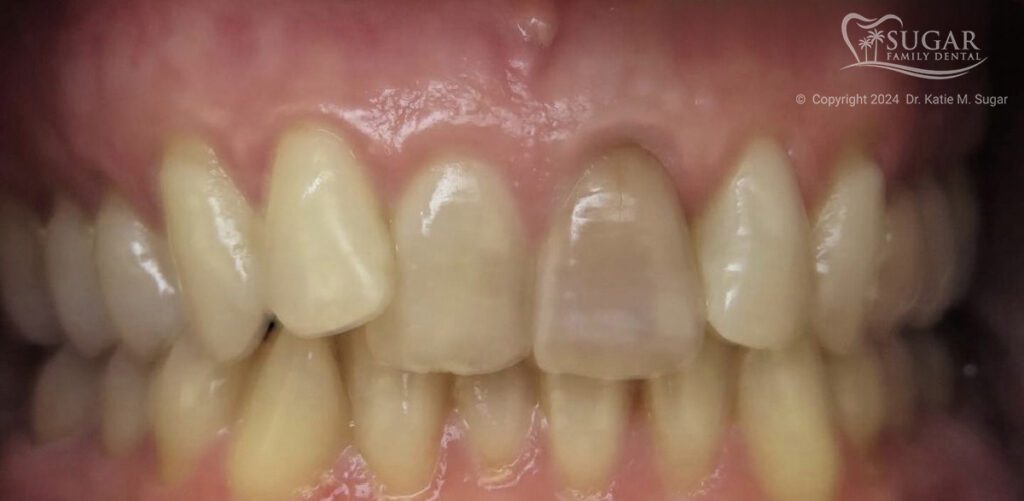 Masking An Endodontically Treated Tooth