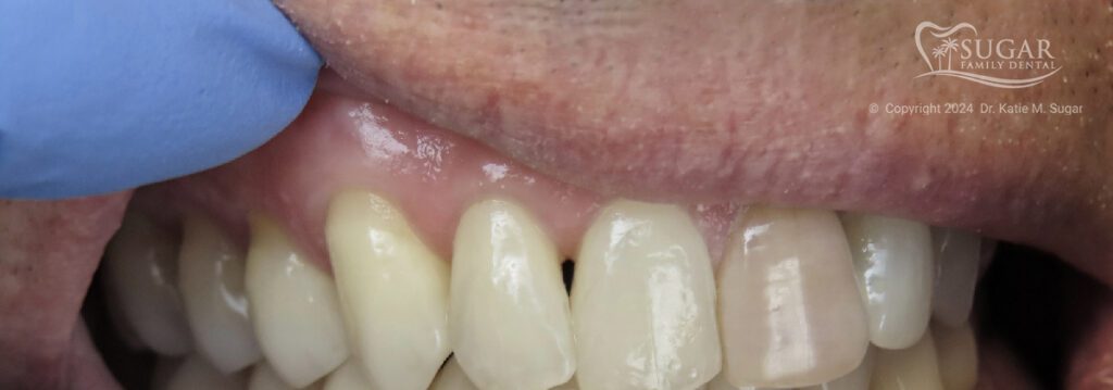 Masking An Endodontically Treated Tooth