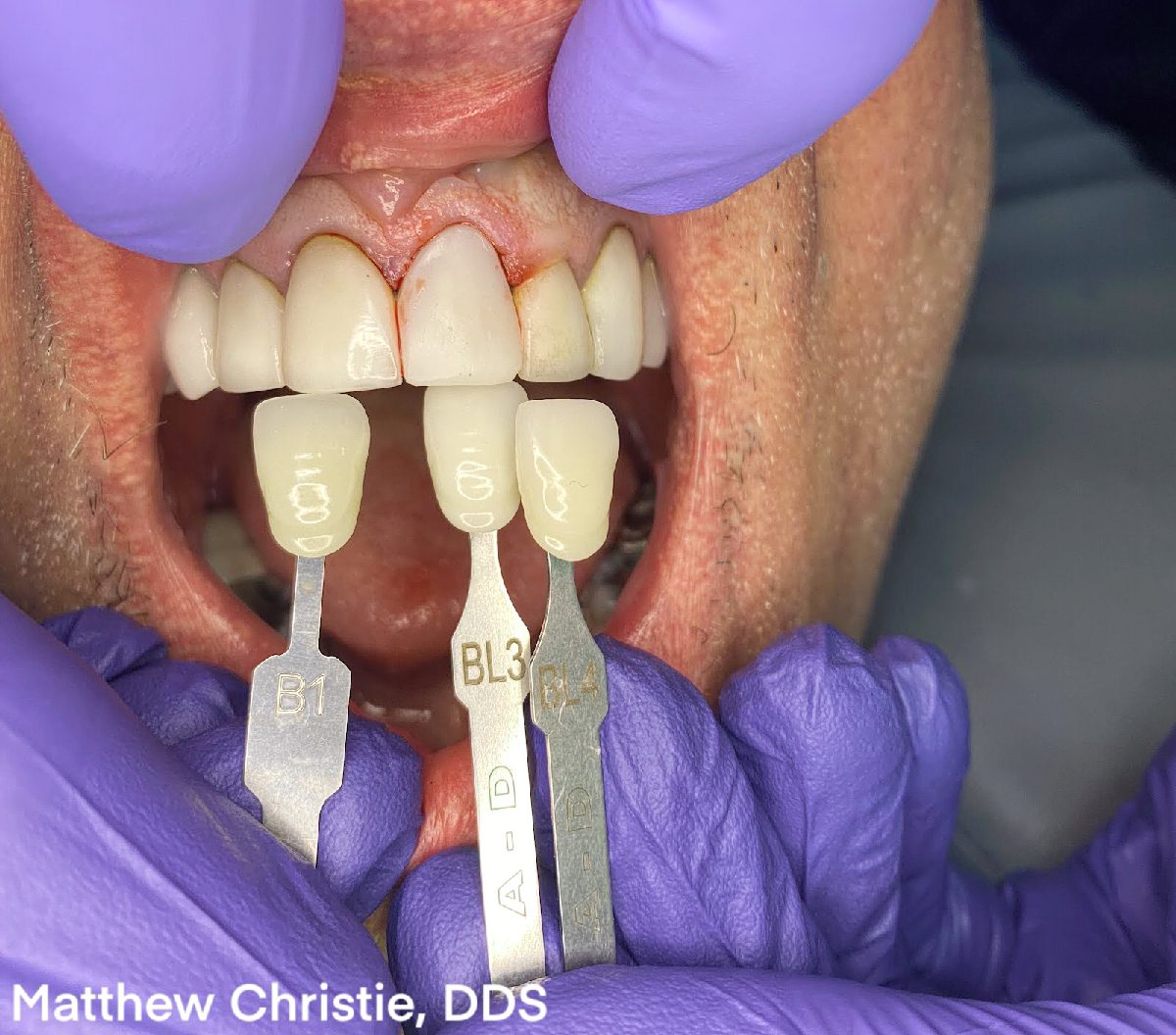PMMA Hybrid: A Solution For Edentulous Patients - Burbank Dental Lab