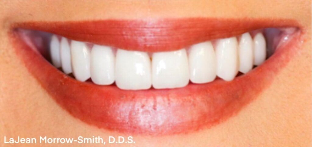 E.max Veneer Cases: Achieving The Best Rwsults